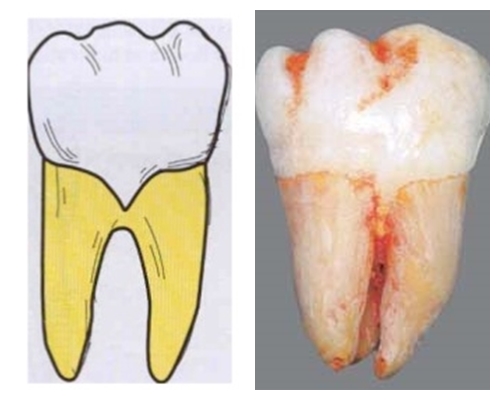 진접치과 내촌치과 치근이개부 병소 뿌리 사이 잇몸 염증 치근 분지부 병소 Cervical Enamel Projection