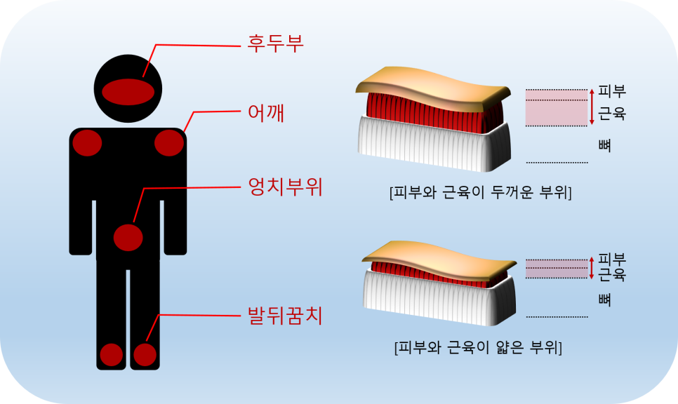 욕창이 잘생기는 신체 부위 네이버 블로그