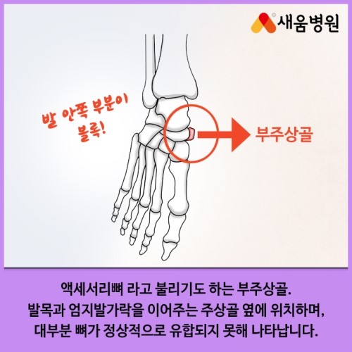 구로구정형외과 발목 안쪽 뼈가 아프면 부주상골 증후군 네이버 블로그