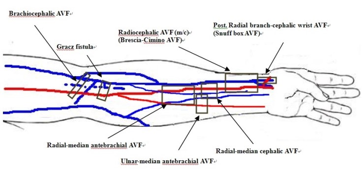 Arteriovenous access (AVF and AVG) : 네이버 블로그