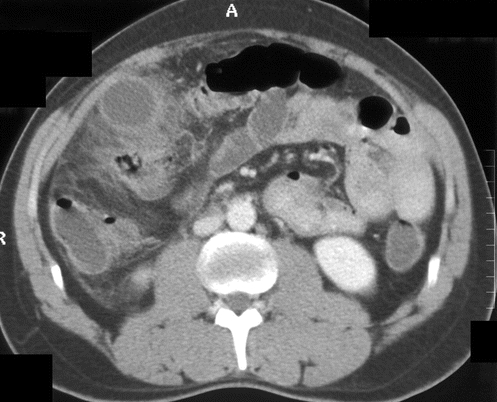 Acute and chronic cholecystitis - CT imaging : 네이버 블로그