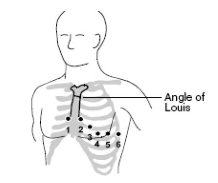 EKG, ECG, 심전도 검사방법, 리드 부착방법 : 네이버 블로그