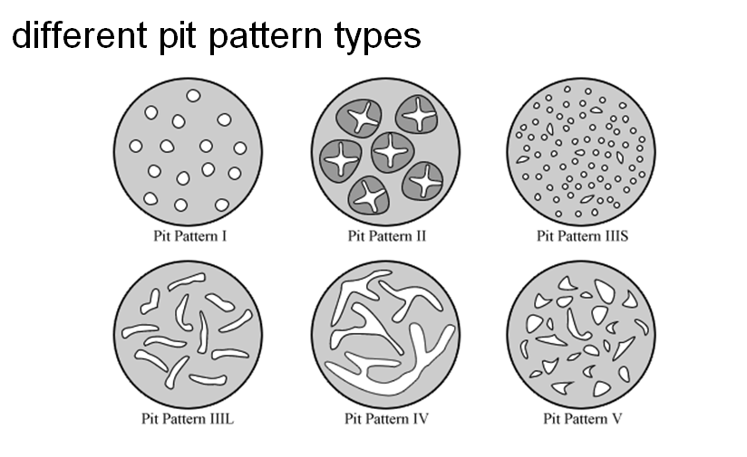 Colon LST classification(Kudo/paris)/pit pattern : 네이버 블로그