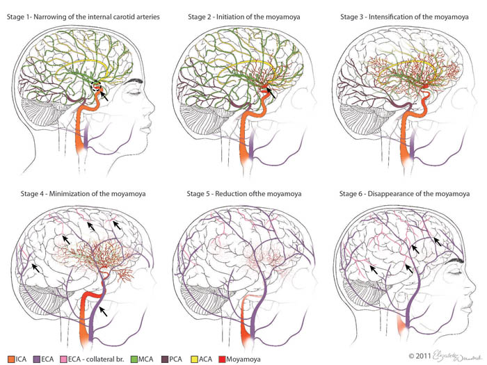 모야모야병(Moyamoya disease)에 대하여 : 네이버 블로그