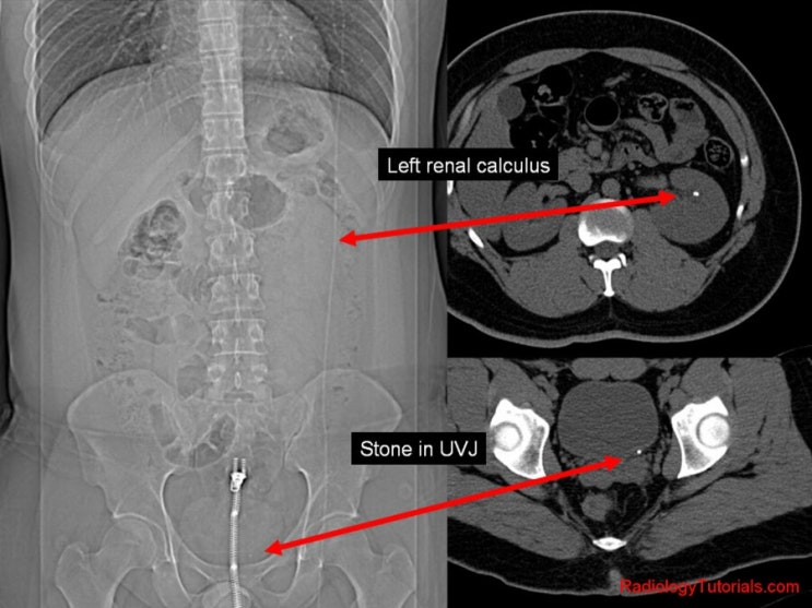 UVJ stone case study : 네이버 블로그